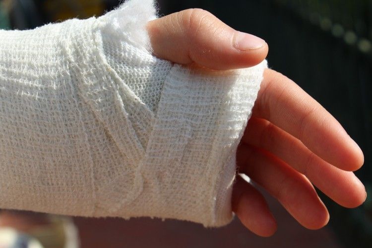 ¿Escayolado en verano? Claves para mantener perfecto el yeso (y tus ...